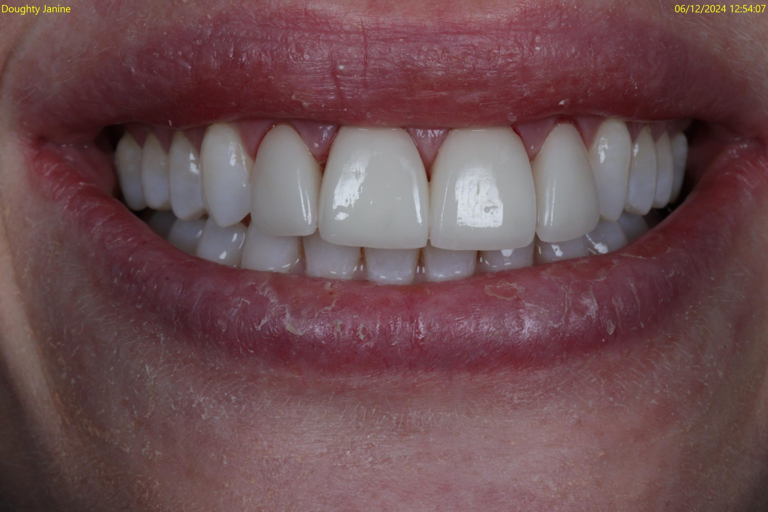 Dental Veneers in Cheshire | Achieving a Perfect Smile