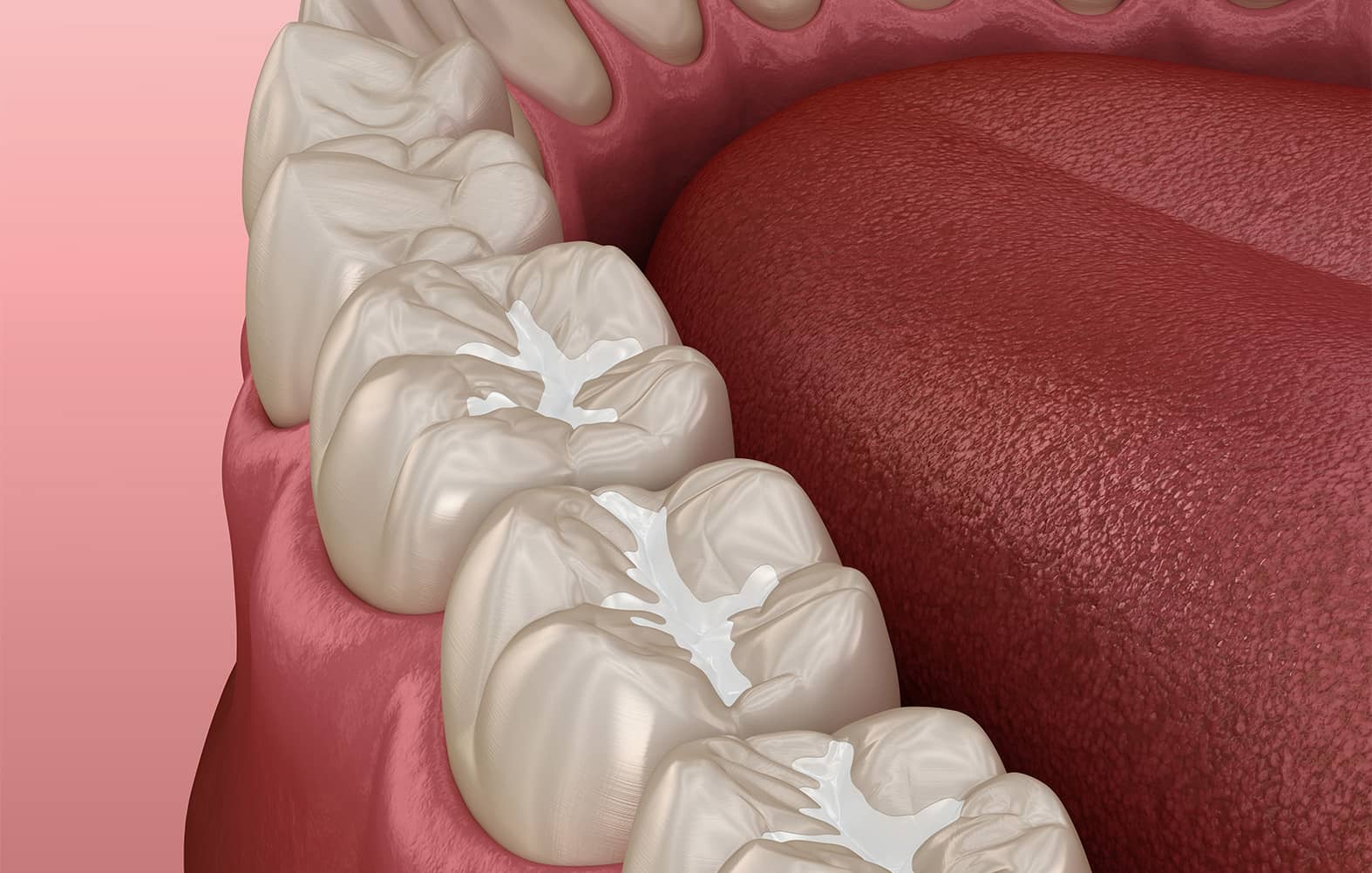 Dental Fillings | Crown Bank Dental Cheshire